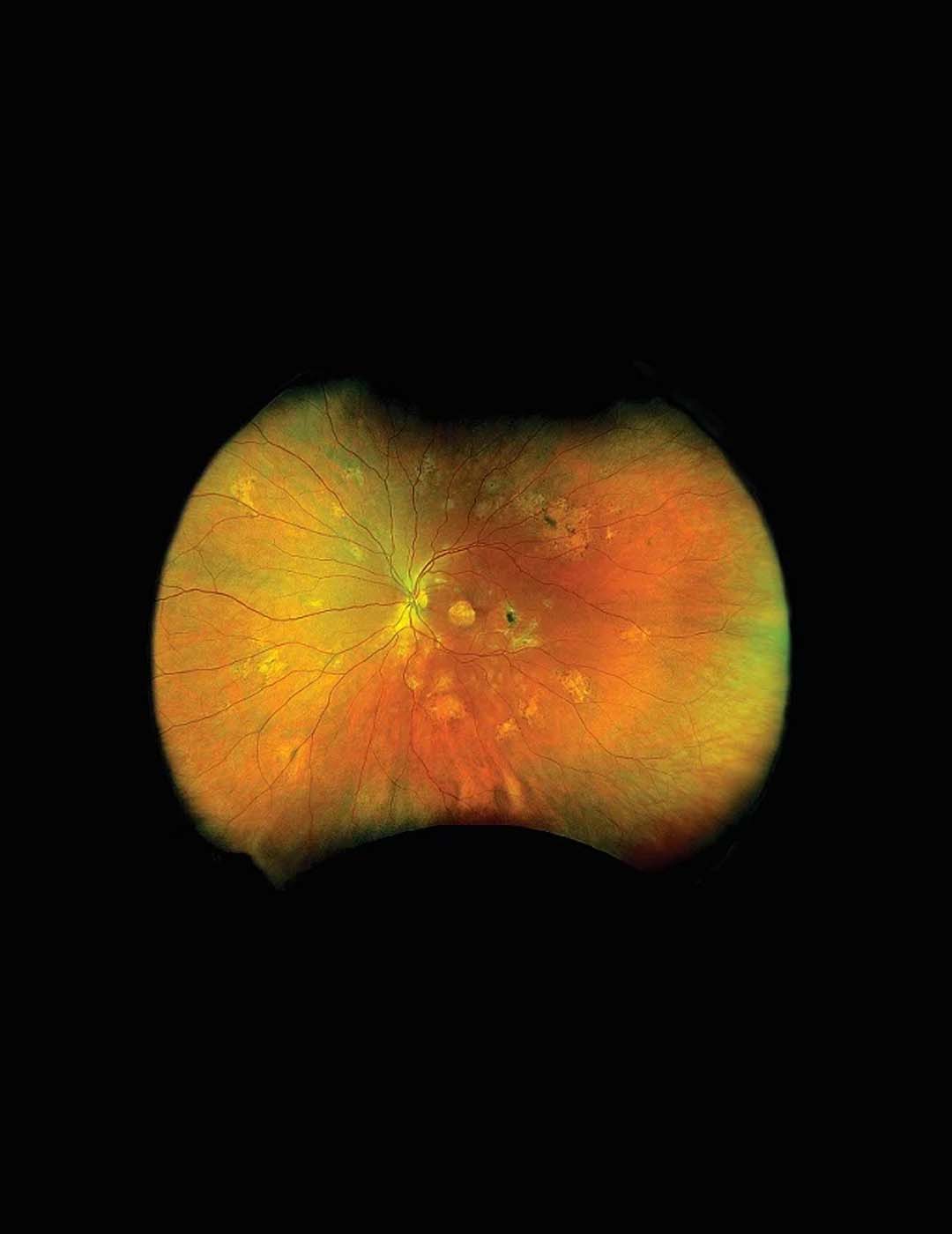 Optomap® scanning captures up to 200 degrees of the back of the eye in ...